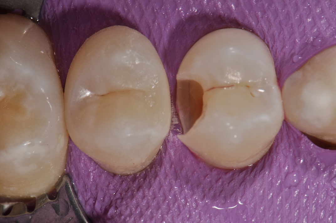 The Actual Extent of a Grade 3 (R3) Carious Lesion (Cavity)