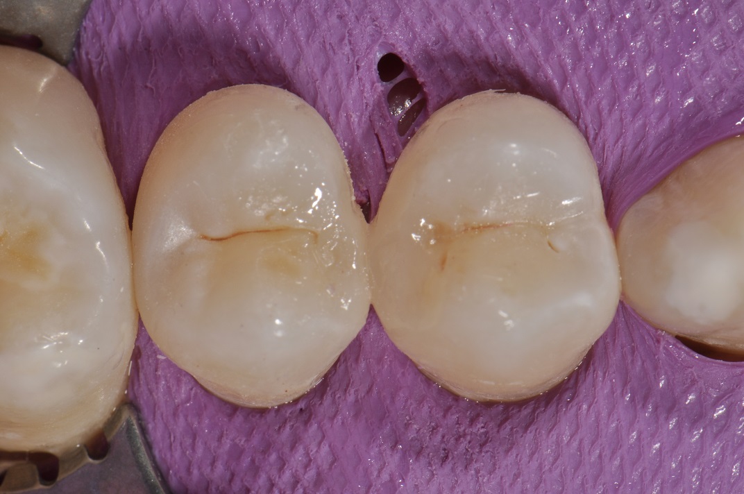 The Actual Extent of a Grade 3 (R3) Carious Lesion (Cavity)
