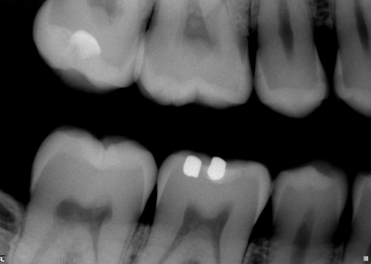 The Actual Extent of a Grade 3 (R3) Carious Lesion (Cavity)