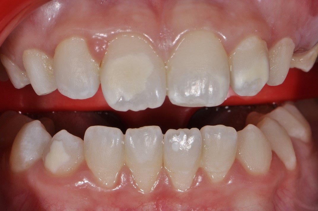 Treatment of White Spots on Teeth | Incisor Hypomineralization