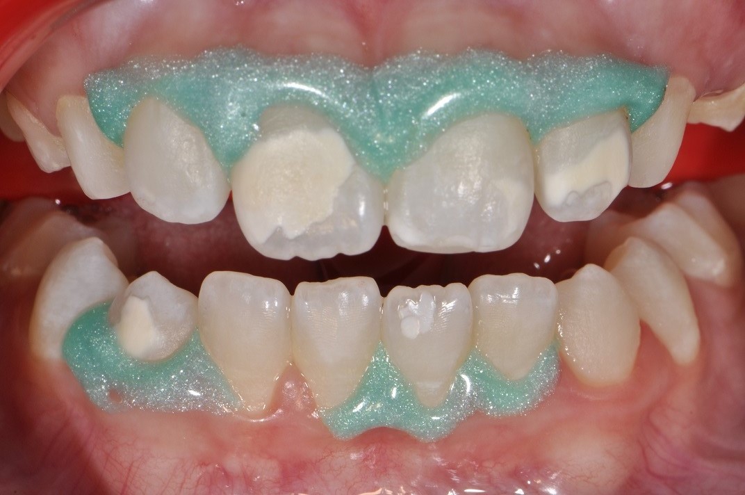 Treatment of White Spots on Teeth | Incisor Hypomineralization