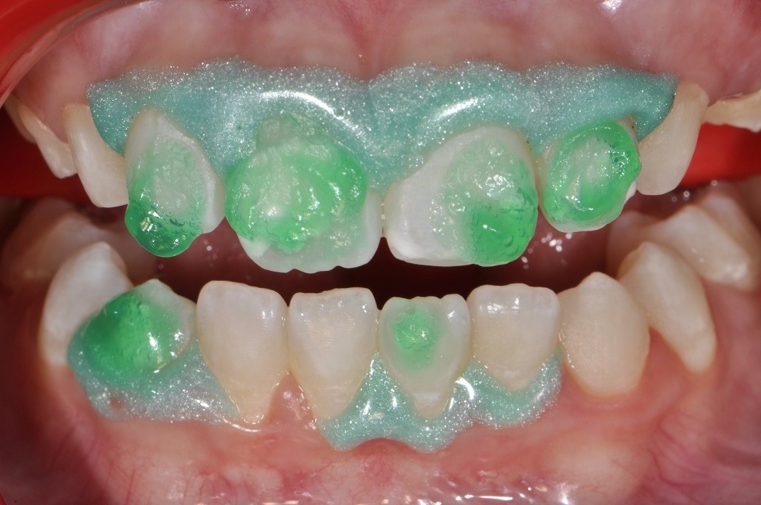 Treatment of White Spots on Teeth | Incisor Hypomineralization