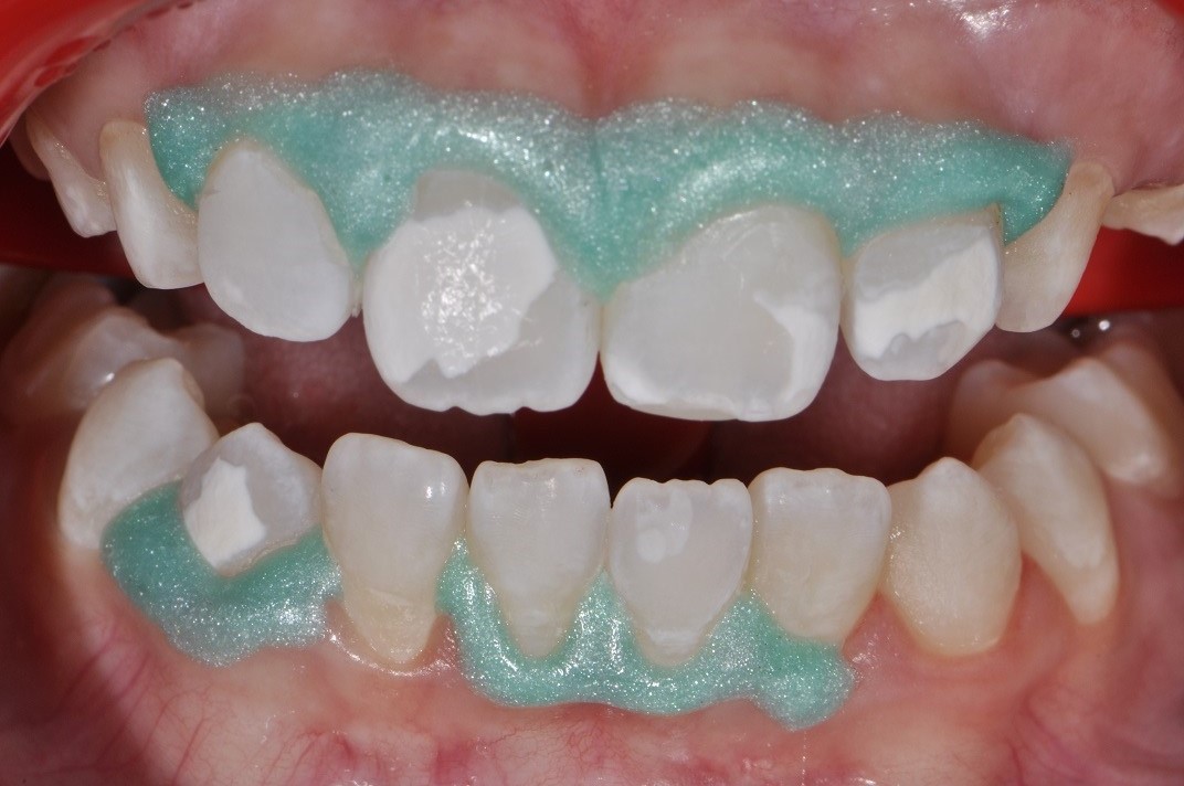 Treatment of White Spots on Teeth | Incisor Hypomineralization