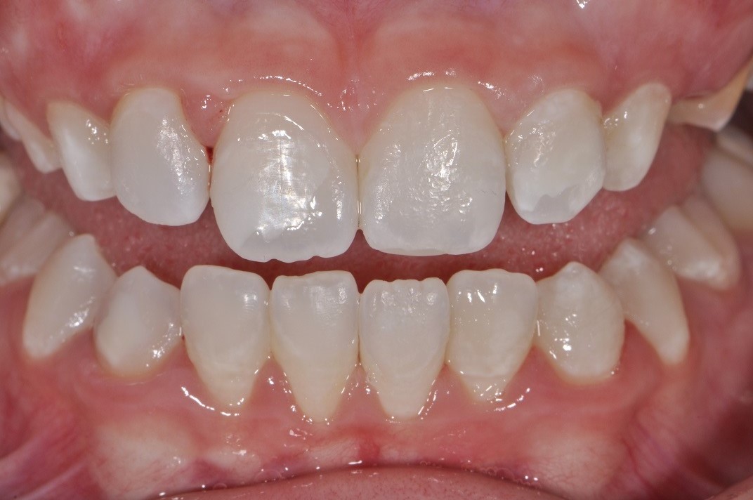 Treatment of White Spots on Teeth | Incisor Hypomineralization