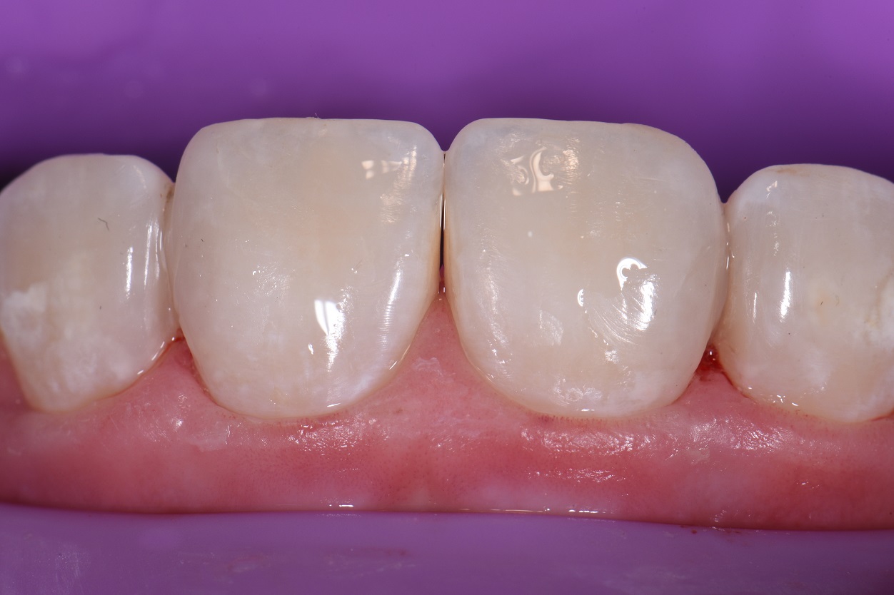 Back to back Cavities between the front teeth | Restorative Dentist ...