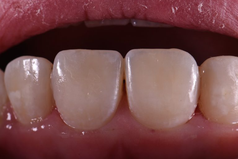 Back to back Cavities between the front teeth | Restorative Dentist ...