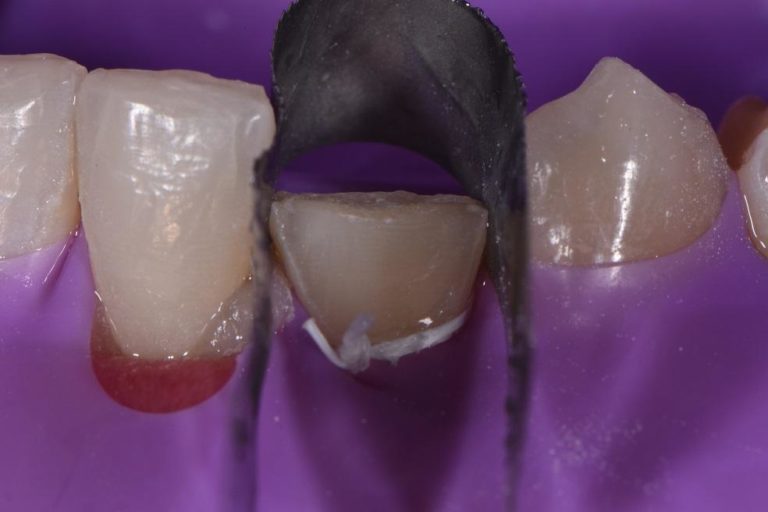 Enamel-Dentin Fracture