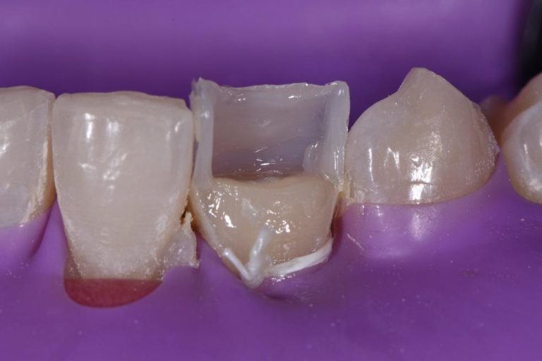 Enamel-Dentin Fracture