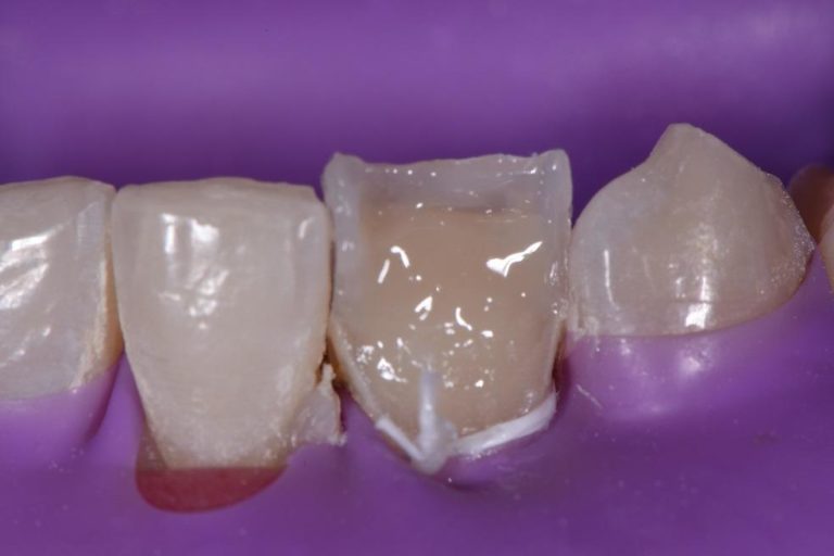 Enamel-Dentin Fracture