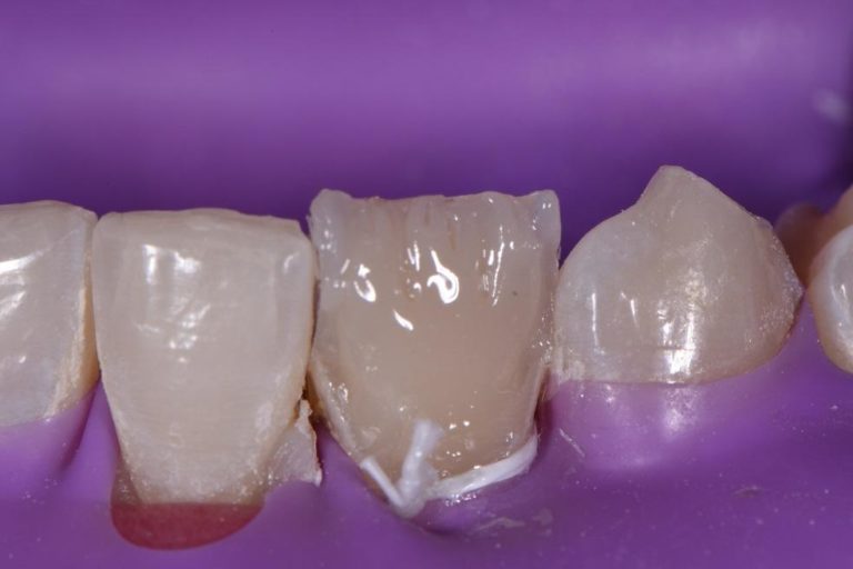 Enamel-Dentin Fracture