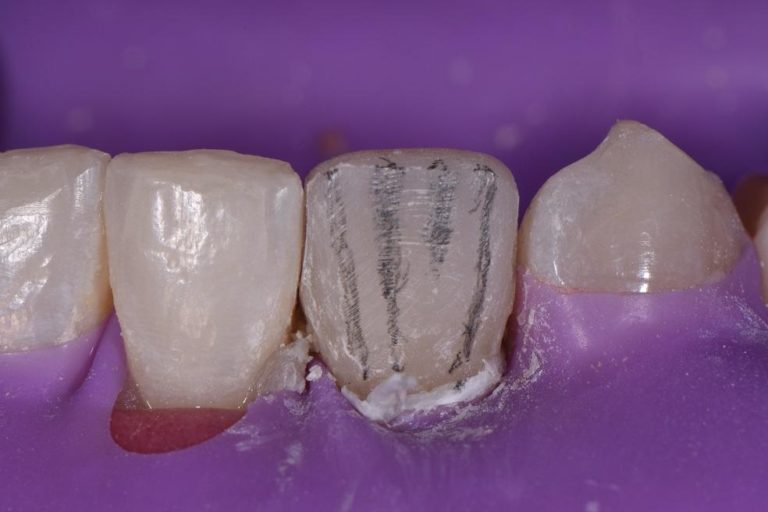 Enamel-Dentin Fracture