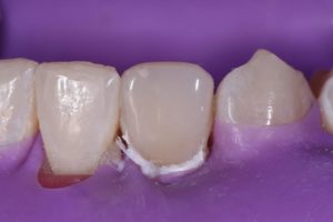 Enamel-Dentin Fracture