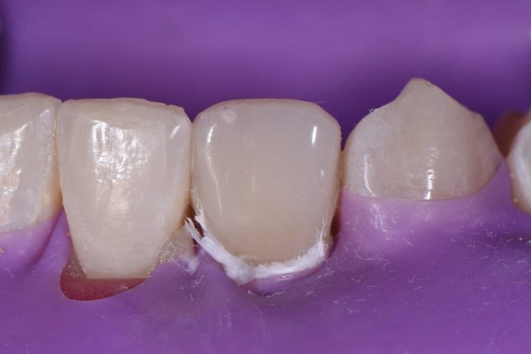 Enamel-Dentin Fracture