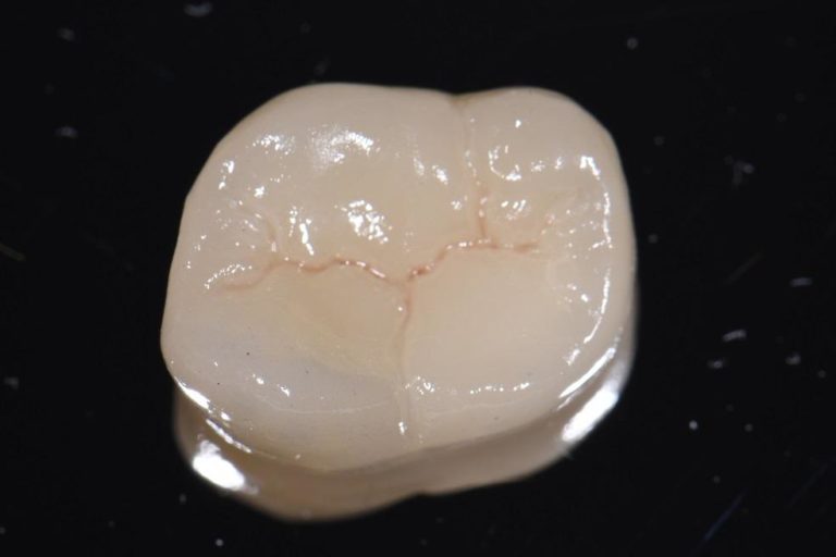 IPS e-max MT on a Rotated Tooth Base
