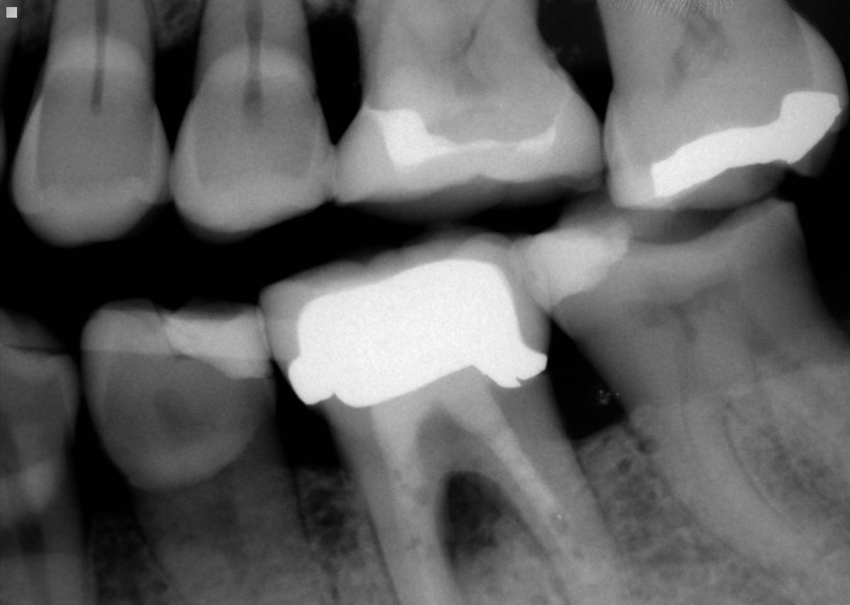 Fractured Restoration Fixed with Crown Fabrication