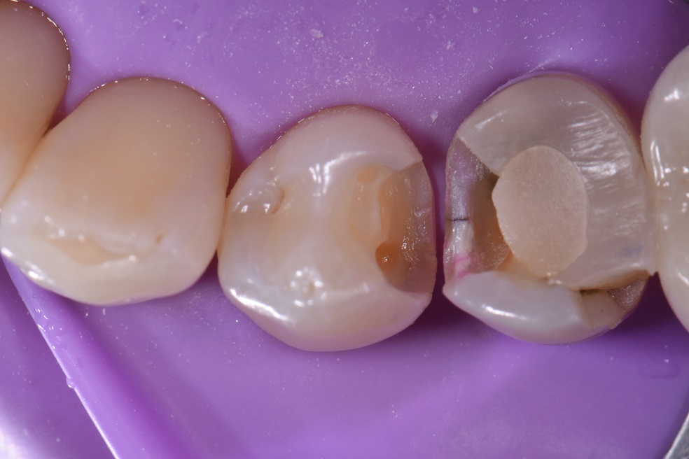 Small Class II's on lower premolars