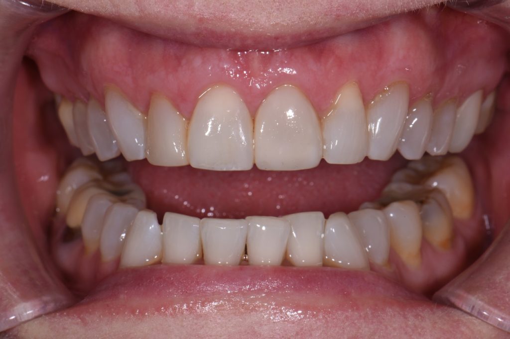 Subtle Changes to Make a Smile more Symmetrical