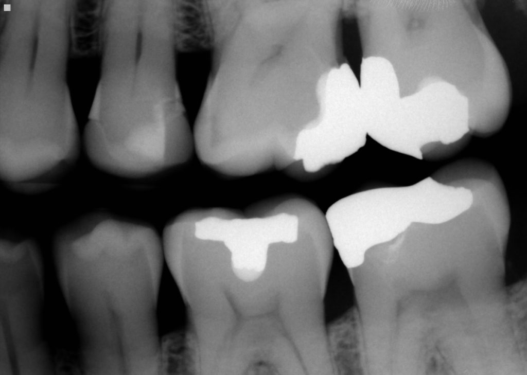 Restoring a fractured molar of a fellow dentist