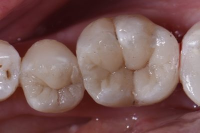Rebuilding teeth with white composite resin fillings