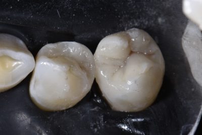Replacing Old Amalgam Restorations