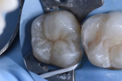 Amalgam Stained Tooth No More