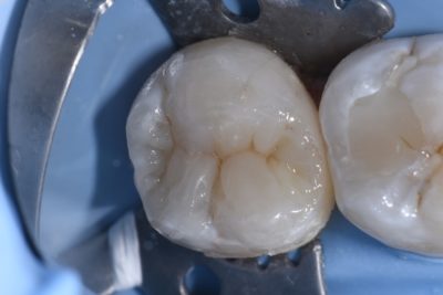 Replacing Old Fillings with Emotion