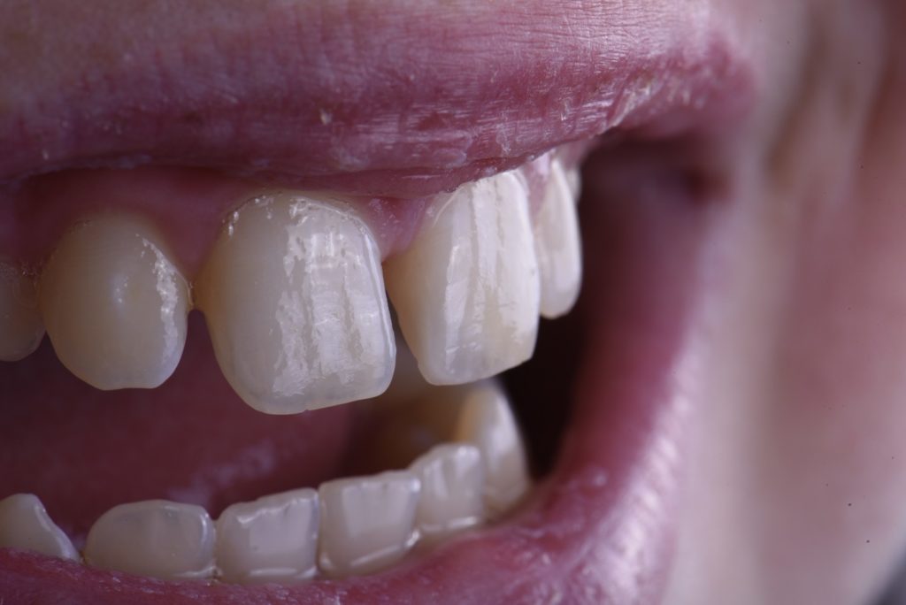 Class IV Fracture Repair using StyleItaliano Whiteology