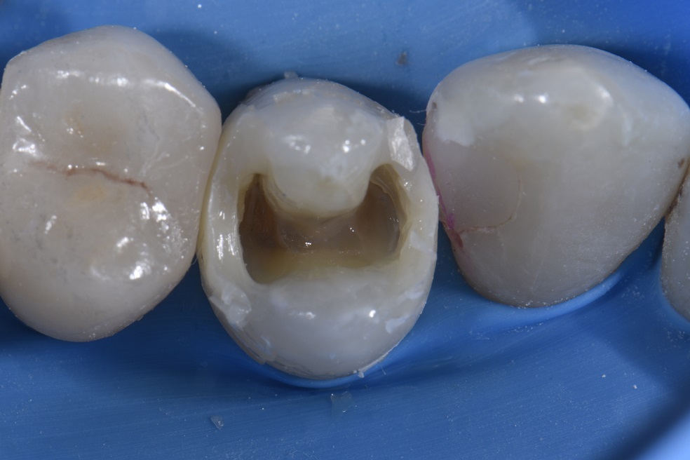 Large premolar rebuilt using a true Modern SuperComposite