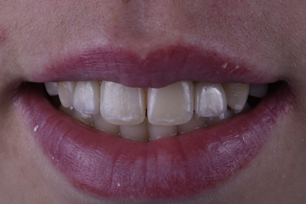 Beautiful Composite Crowns on Mini Transitional Implants