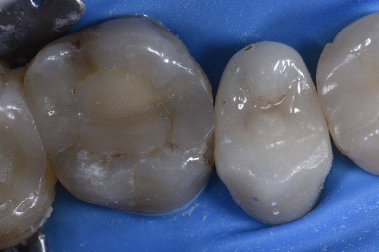 Rebuilding and Reconstructing Complex Teeth