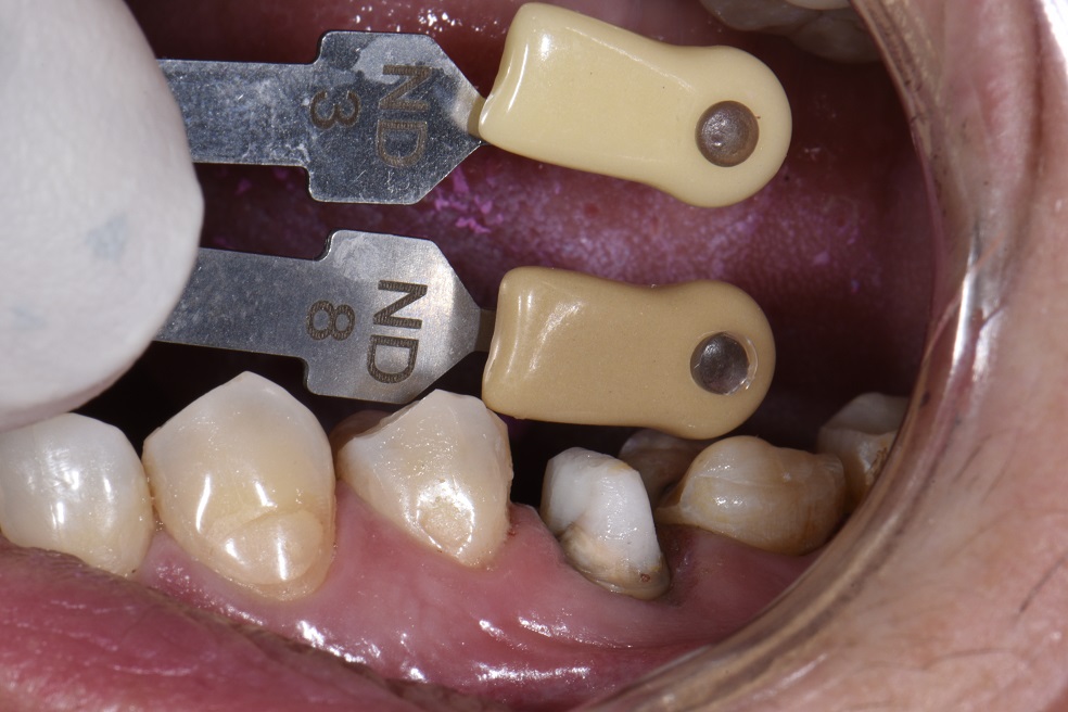 Rebuilding and Reconstructing Complex Teeth