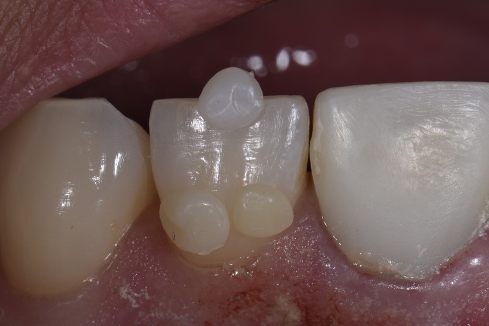 Modification of Temporary Crowns for Improved Color and Contour