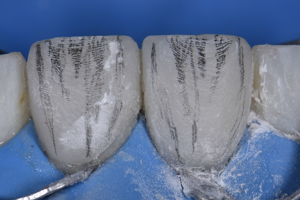 Modification of Temporary Crowns for Improved Color and Contour