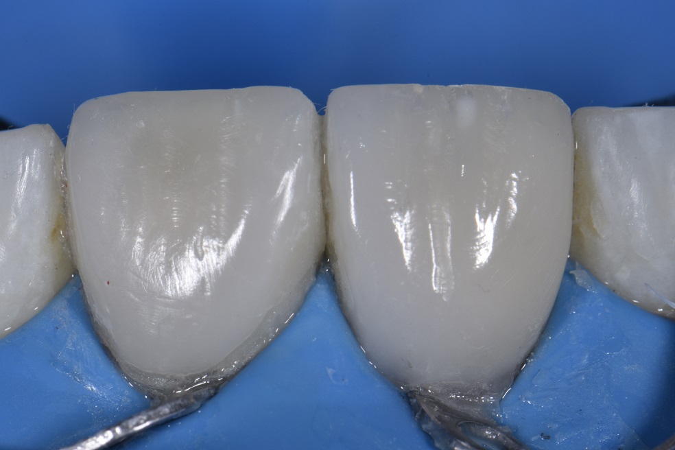 Modification of Temporary Crowns for Improved Color and Contour