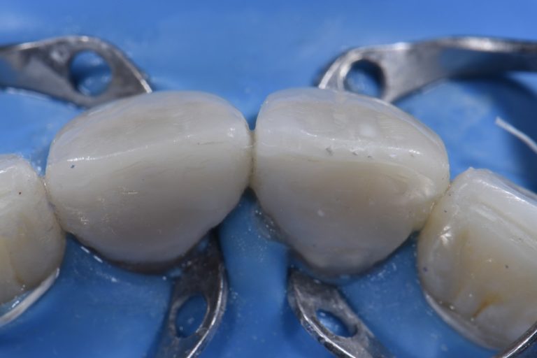Modification of Temporary Crowns for Improved Color and Contour