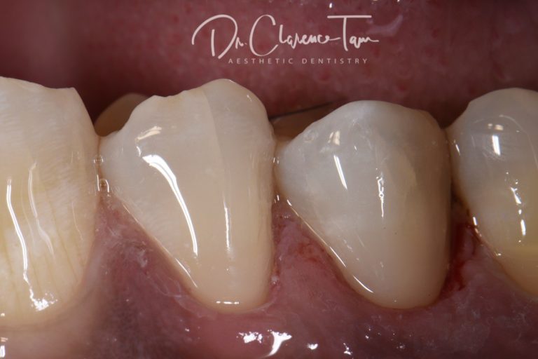 GC Essentia Class V Abrasion Lesions