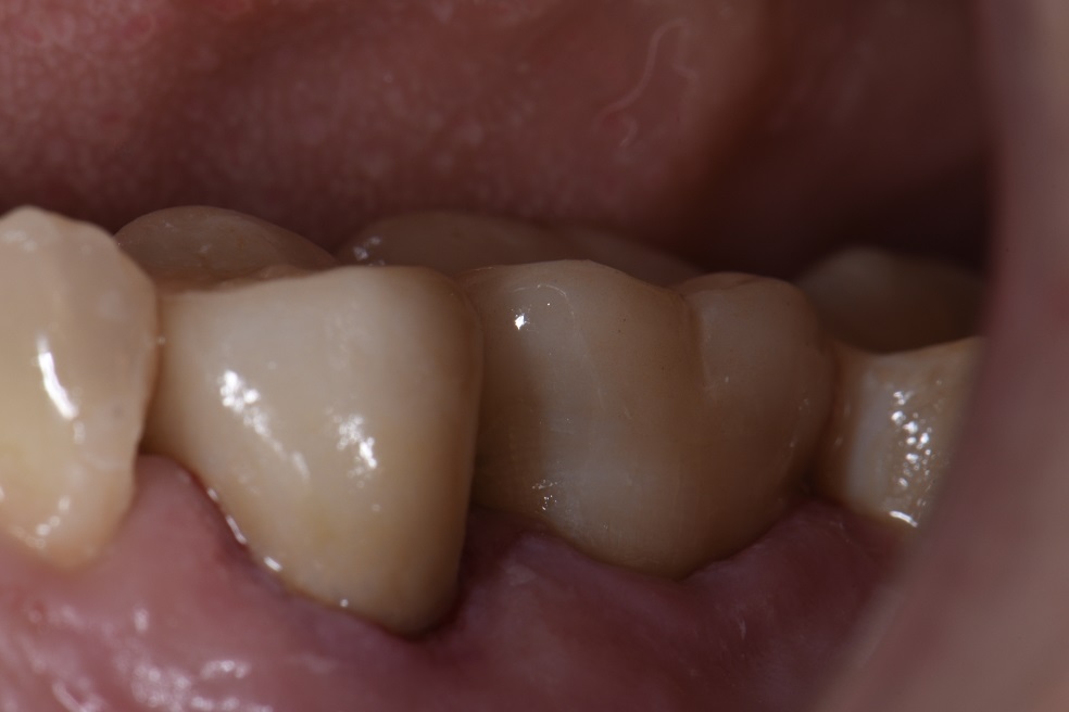 Rebuilding and Reconstructing Complex Teeth