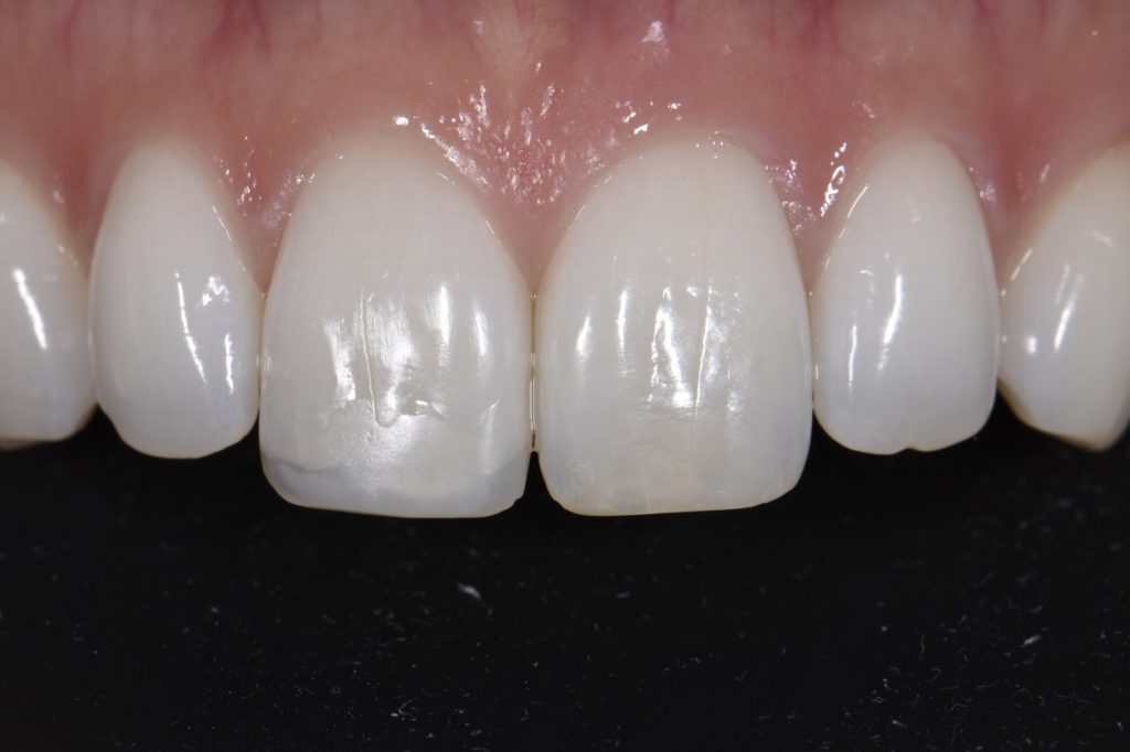 Empress Direct Partial Coverage Composite Restorations