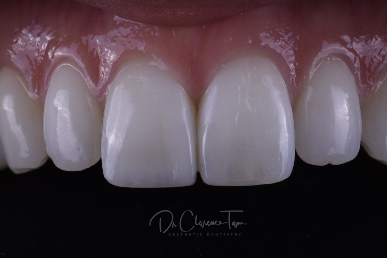 Empress Direct Partial Coverage Composite Restorations