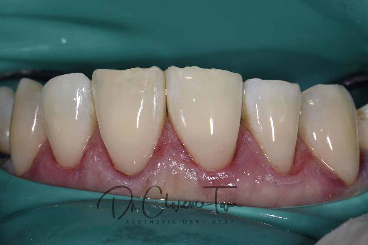 Rejuvenating Front Teeth