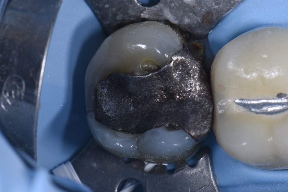 Skulpting Beauty back into Amalgam filled teeth
