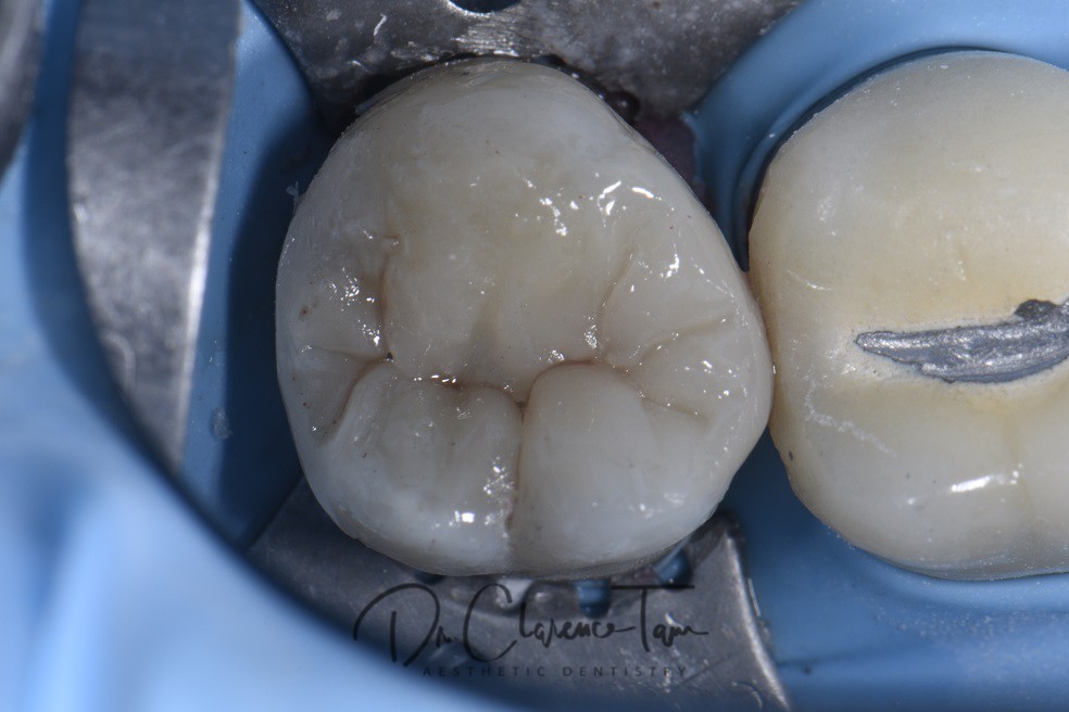Skulpting Beauty back into Amalgam filled teeth