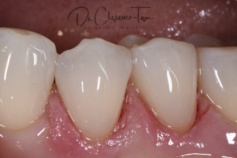 Class V cervical abrasion restorations