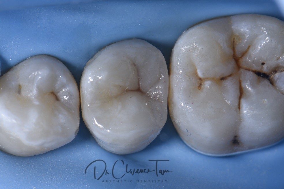 Root Canal Treated Tooth restored provisionally with a Composite ...