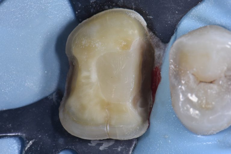 Crownlays - a final attempt to be minimally invasive