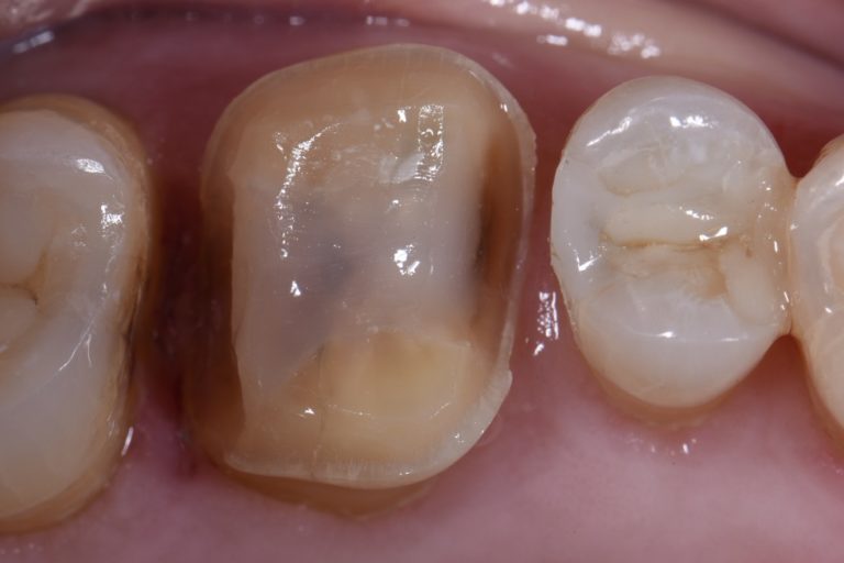 Onlay replacements with IPS e-max MT