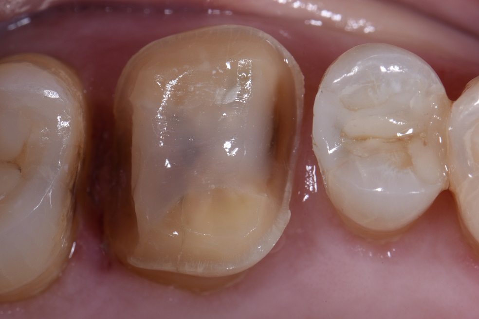 Onlay replacements with IPS e-max MT