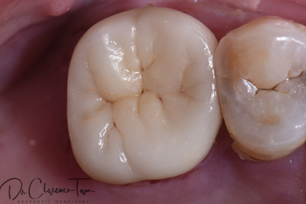 Crownlays - a final attempt to be minimally invasive