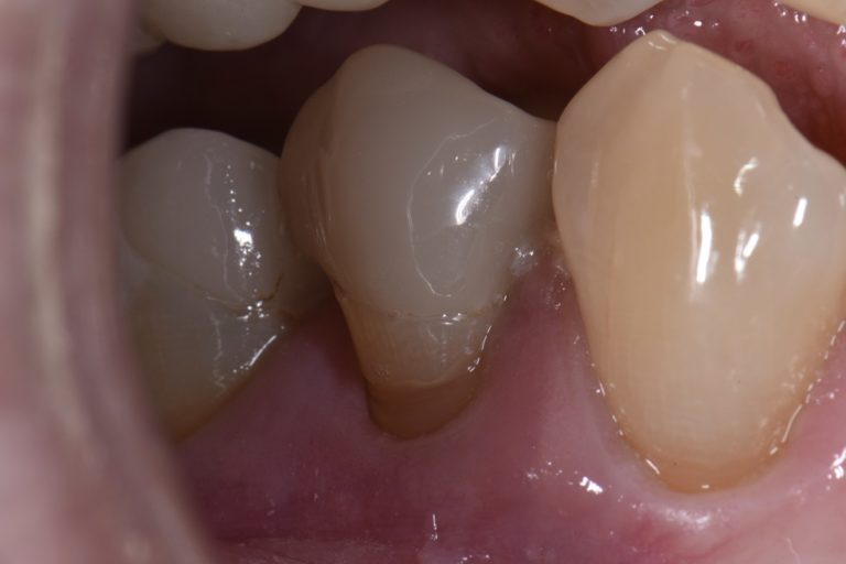 Sealing Old Crown Margins with New Restorations