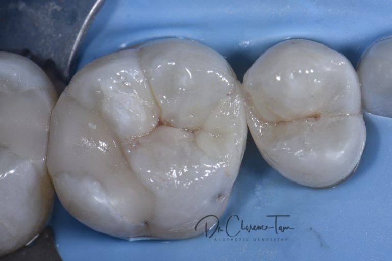 Biomimetic Replacements of Old Amalgam Fillings